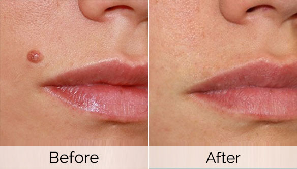 How-to-Remove-Warts-Quickly-and-Naturally-Using-Only-One-Ingredient-1 ...