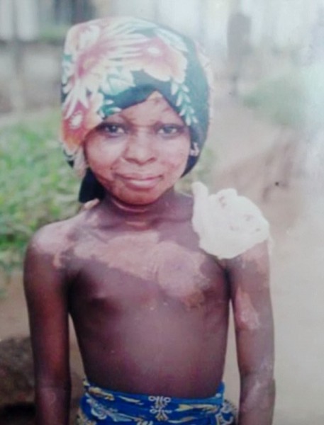 Brave Girl With Burn Scars on Her Face Does Incredible Makeup Tutorials ...