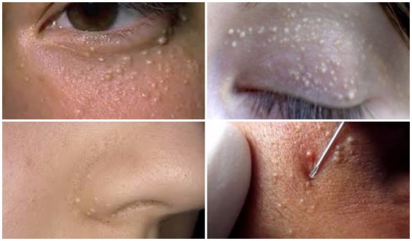 Here is How to Remove the Small Cysts on Your Skin at Home - Women ...