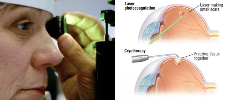 retinal-laser-treatment-save-sight - Women Daily Magazine
