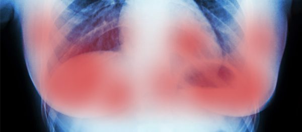 Scientists in Amsterdam Just Destroyed Breast Cancer Tumors in 11 Days ...
