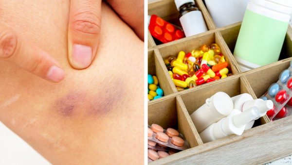 6 Health Problems That Can Cause Bruises On Your Body - Women Daily ...
