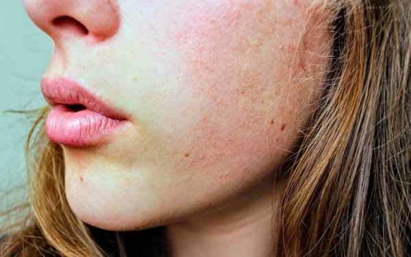 Hormonal Acne - What Is It, And What Should You Do About It? - Women ...