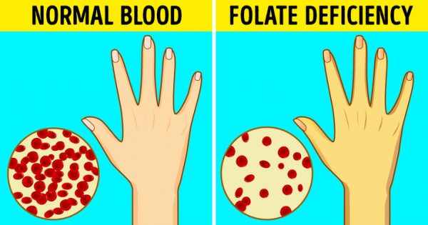 5 Signs That Indicate Your Body Needs More Folic Acid - Women Daily ...