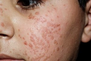 Facial Warts Can Be Truly Scary - Women Daily Magazine
