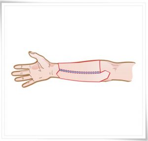 Phalloplasty Female to Male Surgery by Kamol Hospital - Women Daily ...