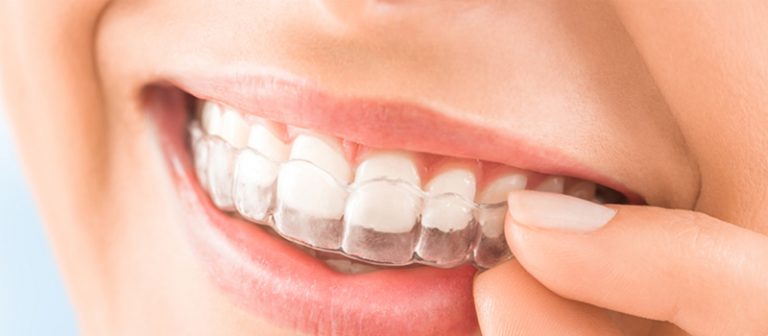 the-benefits-of-invisalign - Women Daily Magazine