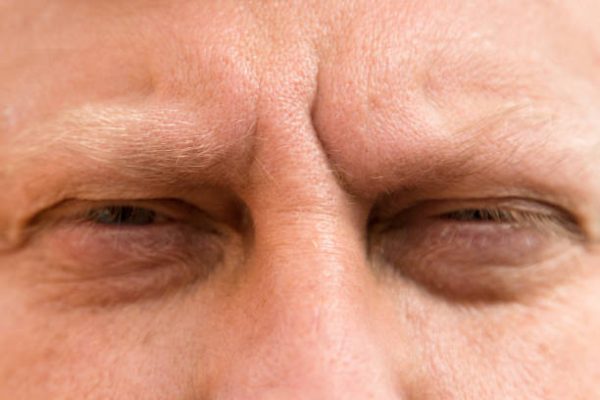 The Beauty Dilemma: Droopy Eyelids and What to Do About Them - Women ...